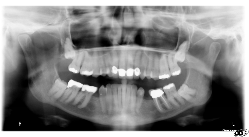 Maxillary Sinuses Dr G s Toothpix Maxillary Sinuses Dr G s Toothpix