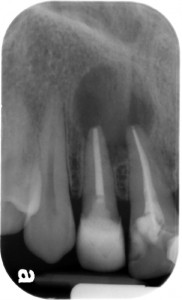 Periapical / Radicular cyst – Dr. G's Toothpix