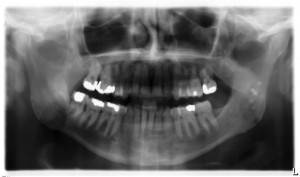 Case of the Week: Tonsiliths – Dr. G's Toothpix
