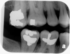 Periodontal radiographic assessment: Normal appearances – Dr. G's Toothpix