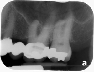 Anatomy Monday: Posterior Superior Alveolar Canal – Dr. G's Toothpix