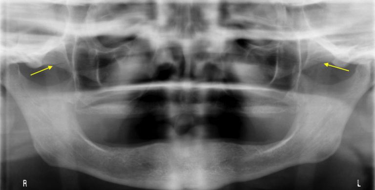 Anatomy Monday: Zygomatico-temporal suture – Dr. G's Toothpix