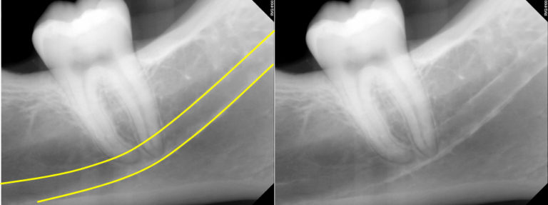 Anatomy Monday Canals On Intraoral Radiographs Dr Gs Toothpix