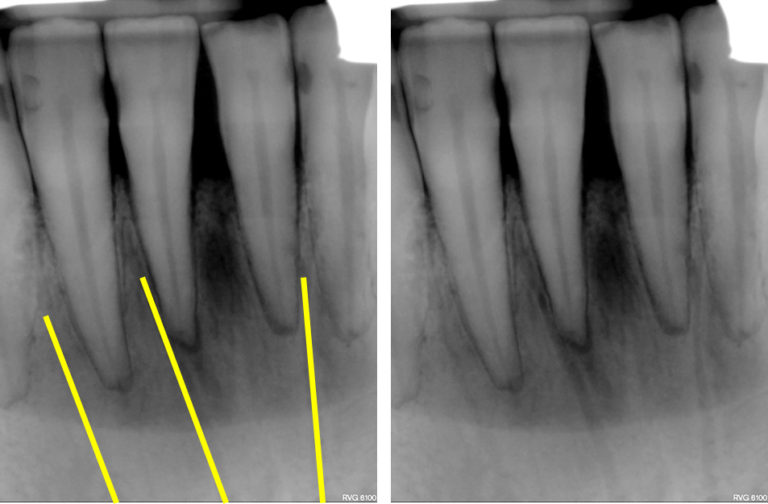 Anatomy Monday Foramina On Intraoral Radiographs Dr Gs Toothpix