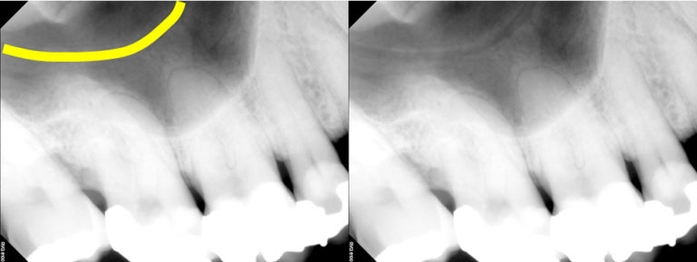 Anatomy Monday: Canals on Intraoral Radiographs – Dr. G's Toothpix
