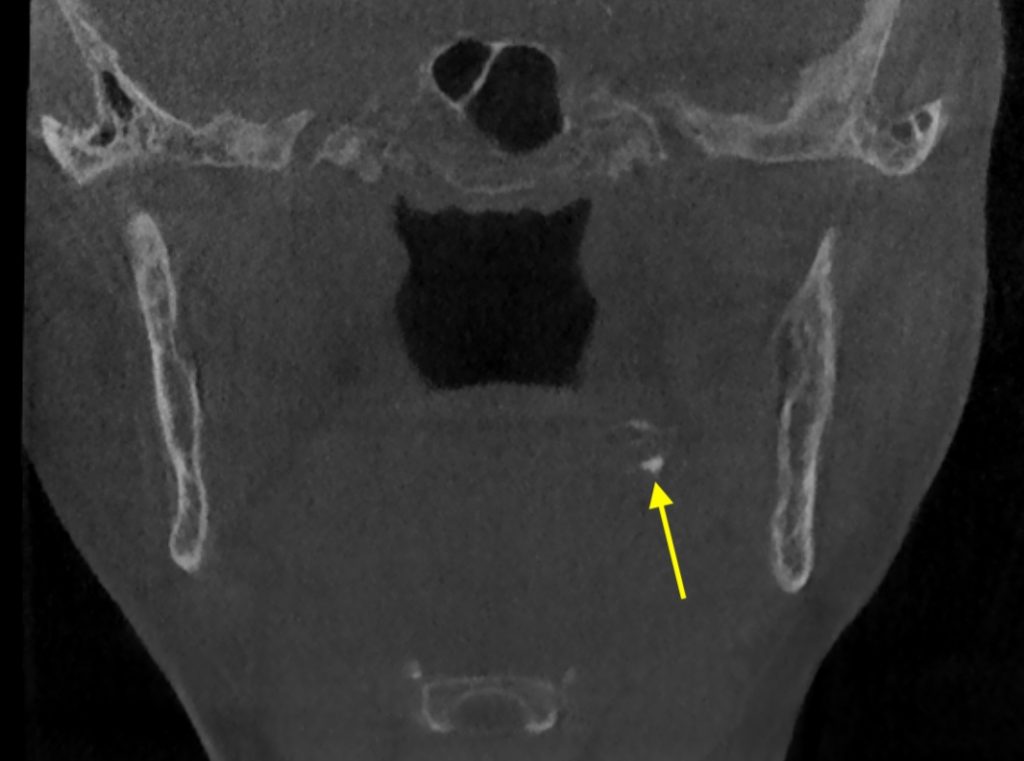 Tonsiliths – Dr. G's Toothpix