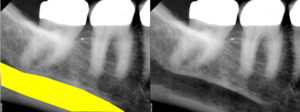Anatomy Monday: Anatomy on Mandibular Periapical Radiographs – Dr. G's ...